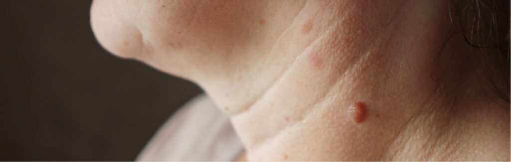 Warts Treatment Berkeley CA - Verruca Piedmont CA